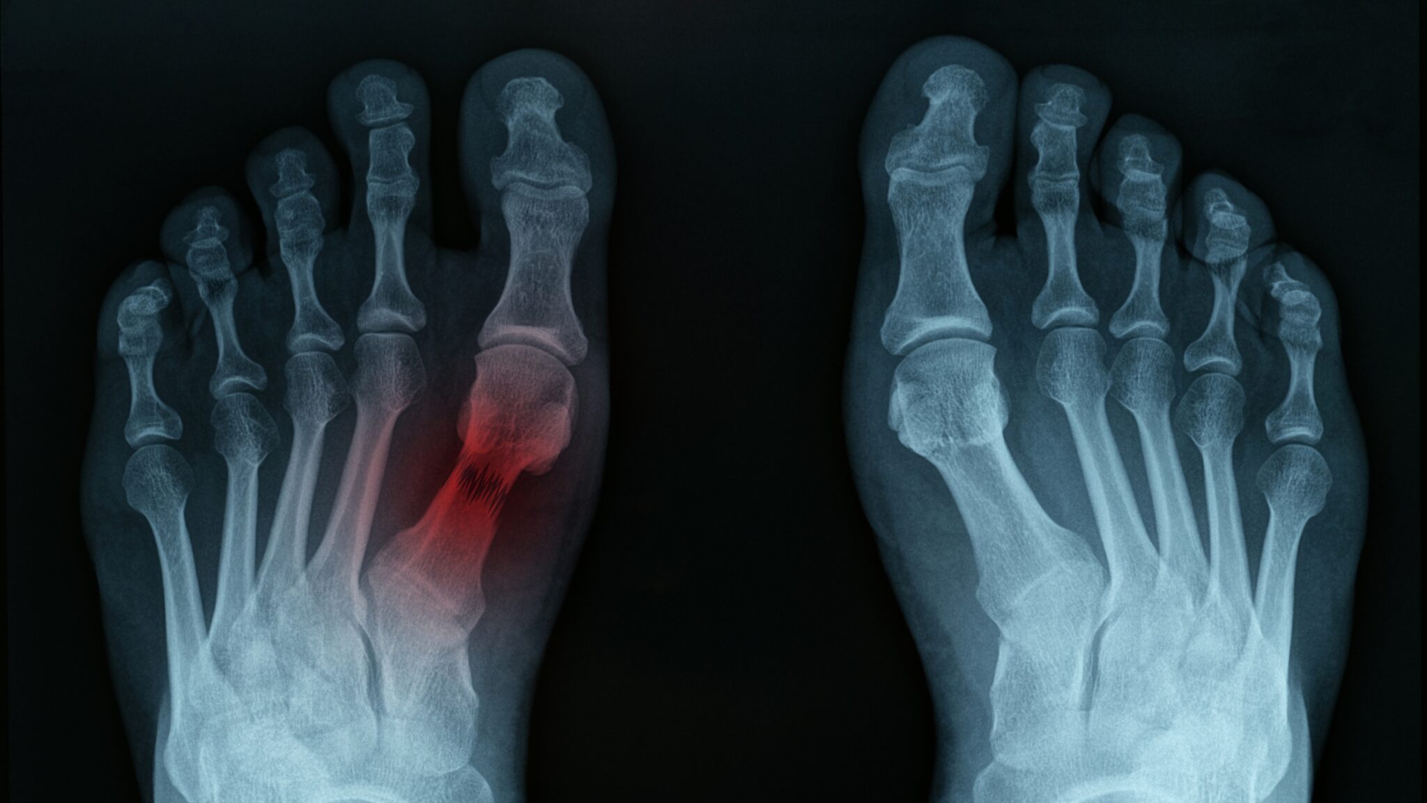 Hairline Fracture: Causes, Symptoms, and Treatment - Salus Clinics and ...